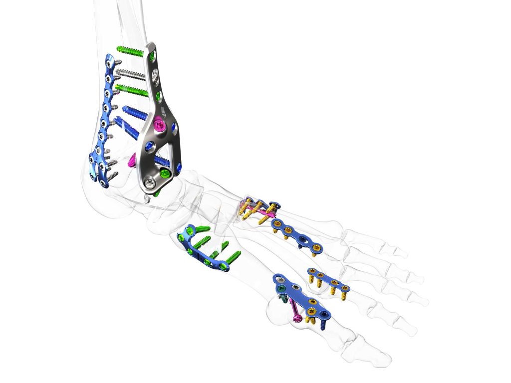Lower Extremity | Extremity Medical